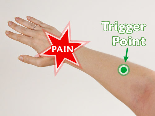 Reduce hand pain by releasing your trigger points | PlanetJune by June ...